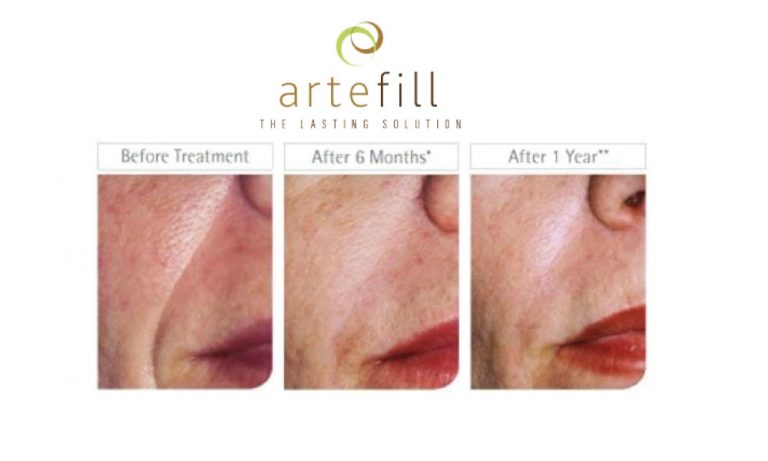 artefill | The Med Spot