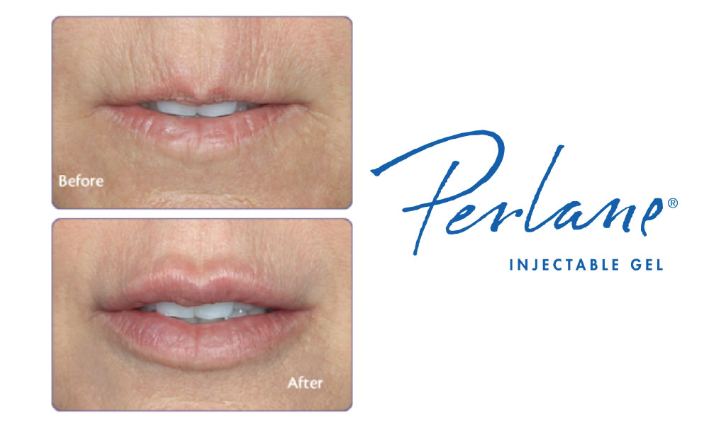 perlane | The Med Spot