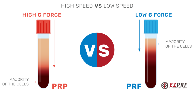 prp vs prf | The Med Spot